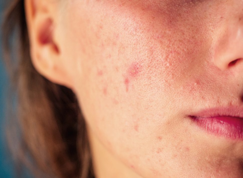 13 Foods Dermatologists Say Make Your Skin Worse — Eat This Not That
