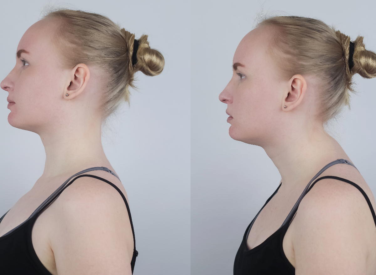 5 Neck Hump Exercises That Will Save Your Posture